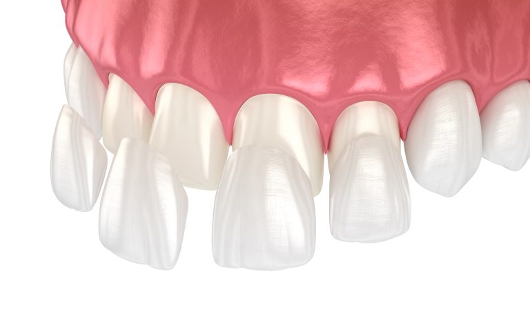 Porcelain Veneers Cost, Uses, & Procedure | Dos Caminos Dental