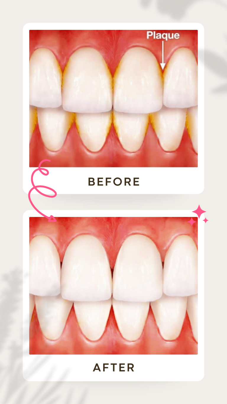 What Is Dental Plaque? Causes, Symptoms, & How To Remove It