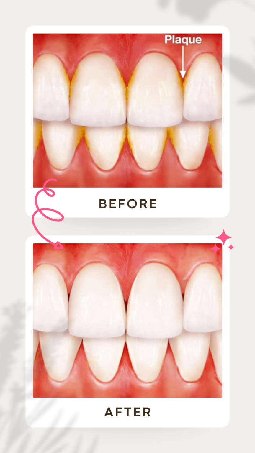 What Is Dental Plaque? Causes, Symptoms, & How To Remove It